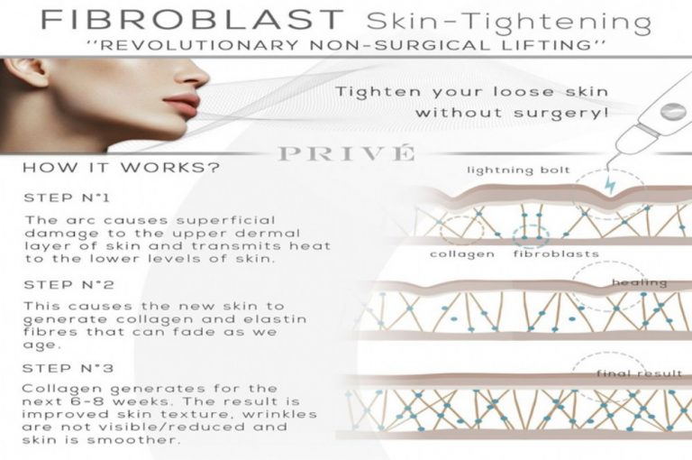 Plasma Fibroblast Skin Tightening Revolutionary Non-Surgical Lifting ...
